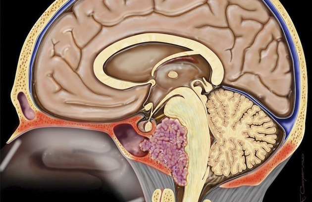 Skull base chordomas, chondrosarcomas - Neuroendo